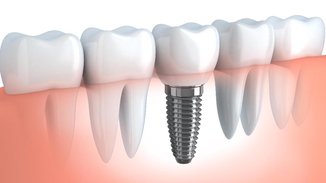 Implants to Replace Teeth | Nola Dentures & General Dentistry